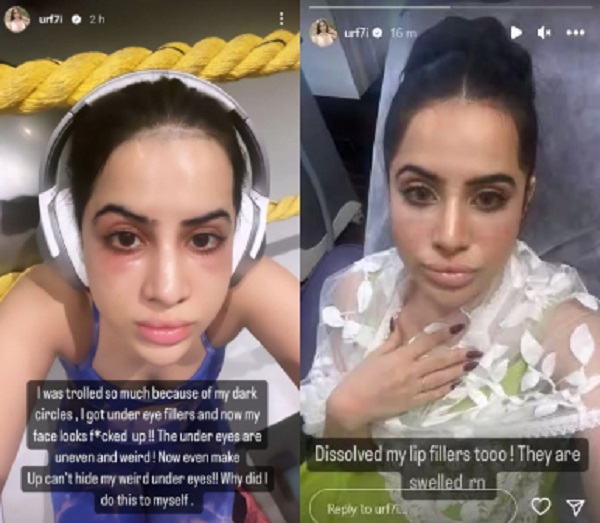 My Face Looks F*cked Up: Urfi Javed Reveals Her Under-Eye Fillers Went ...