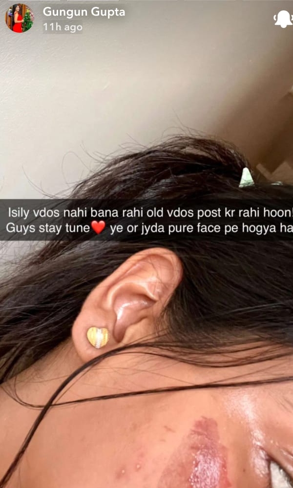 Gungun Gupta New Viral Pic | Gungun Gupta Face Injured | Gungun Gupta Accident | Gungun Gupta ...