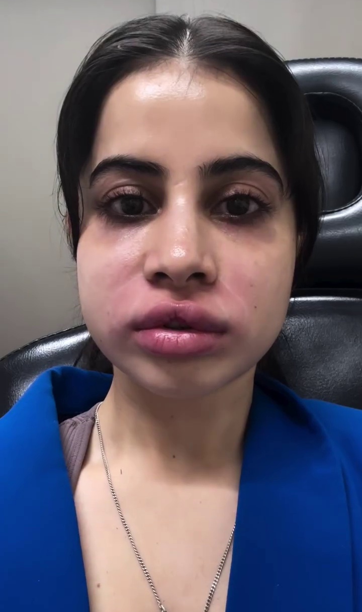 Uorfi Javed Goes Viral After Lip Filler Reveal | Why Uorfi Javed Is ...
